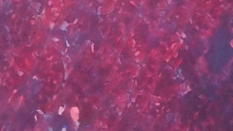 Dermlite DL5 - Erythrasma | Dermatoscopes.com